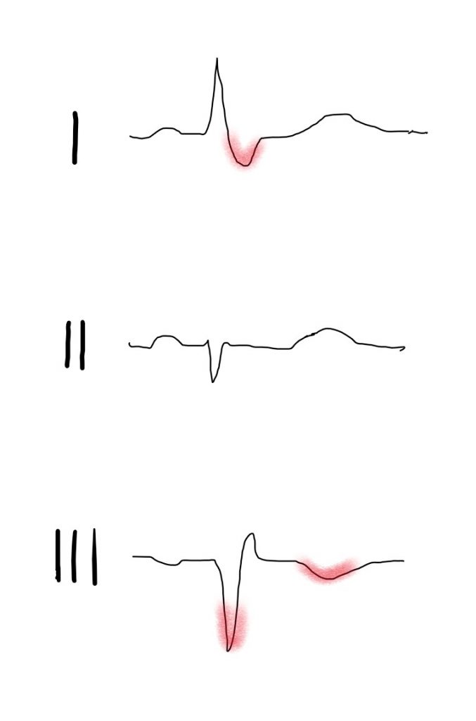 EKG bei V.a. LAE – Schlag´s nach!